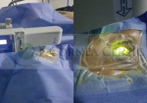 Corneal Crosslinking Hospital in Ahmedabad, Gujarat | C3R | CXL ...